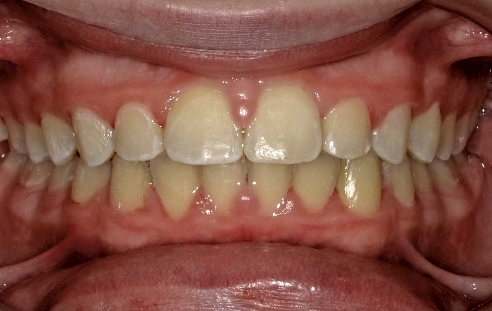 Confluence of Technologies: A Custom Bracket System and Teledentistry ...