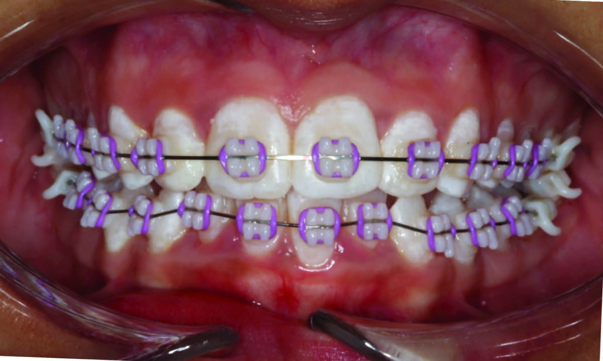 How 3D Printing Makes Hybrid Orthodontic Treatment Possible ...