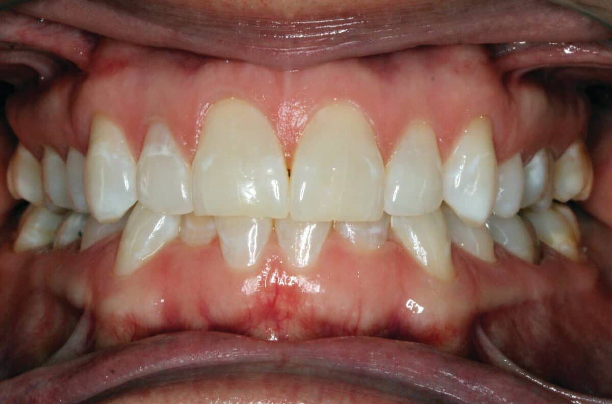 Clear Aligner Management of Adult Orthodontic Relapse Case ...