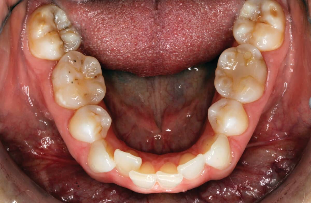 Clear Aligner Management of Adult Orthodontic Relapse Case ...