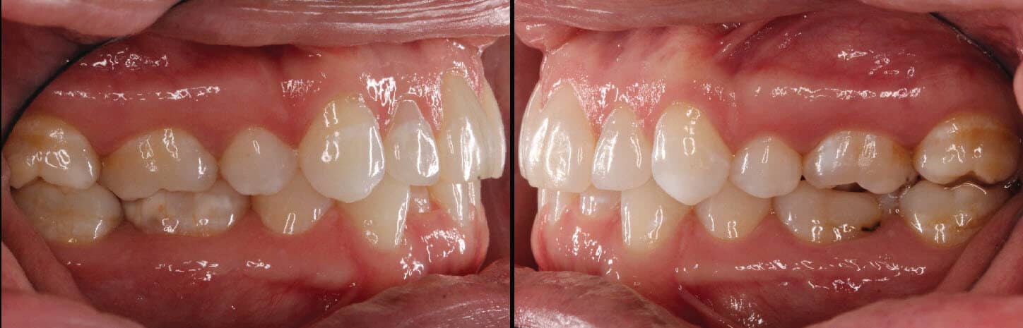 Clear Aligner Management of Adult Orthodontic Relapse Case ...