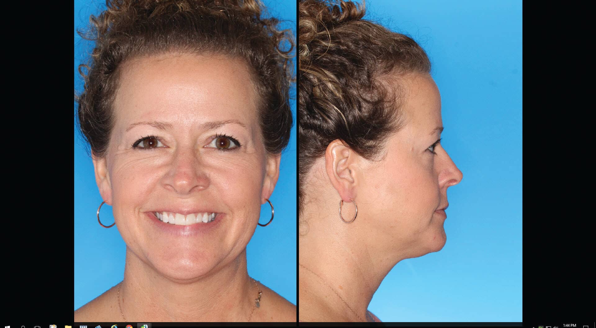 Clear Aligner Management of Adult Orthodontic Relapse Case ...