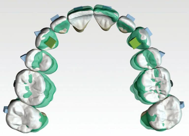 Clear Aligner Management of Adult Orthodontic Relapse Case ...