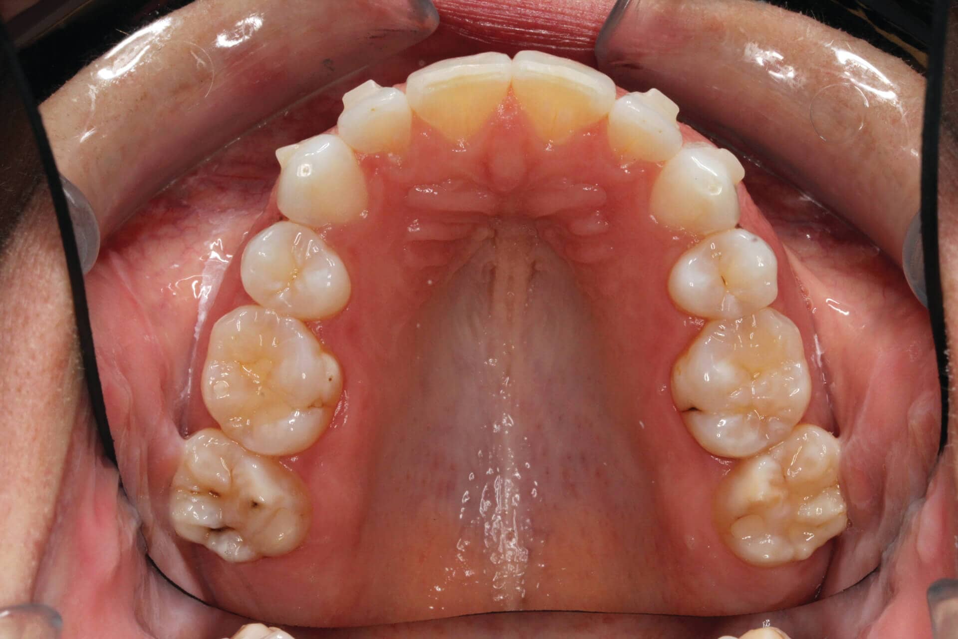 Clear Aligner Management of Adult Orthodontic Relapse Case ...