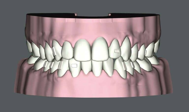 SureSmile Aligners and the Class I with Moderate Class III Pattern ...