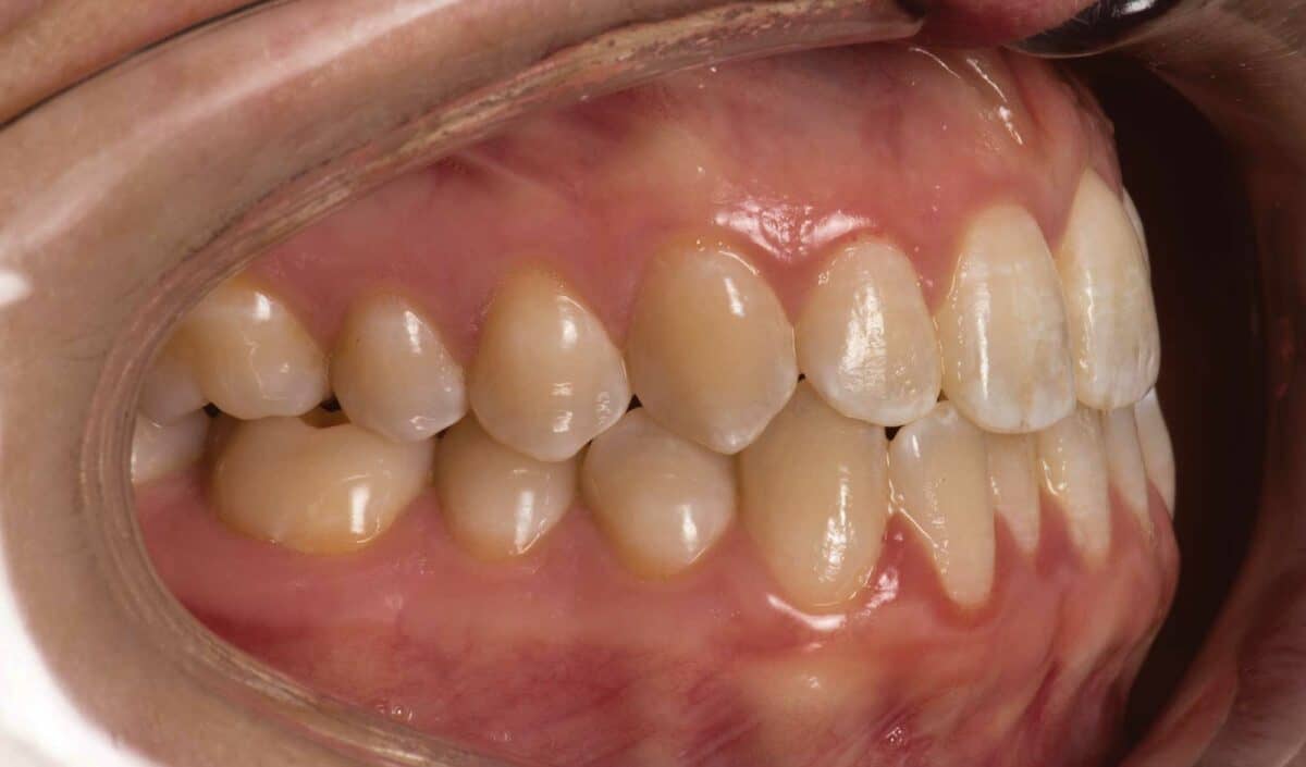 SureSmile Aligners and the Class I with Moderate Class III Pattern ...