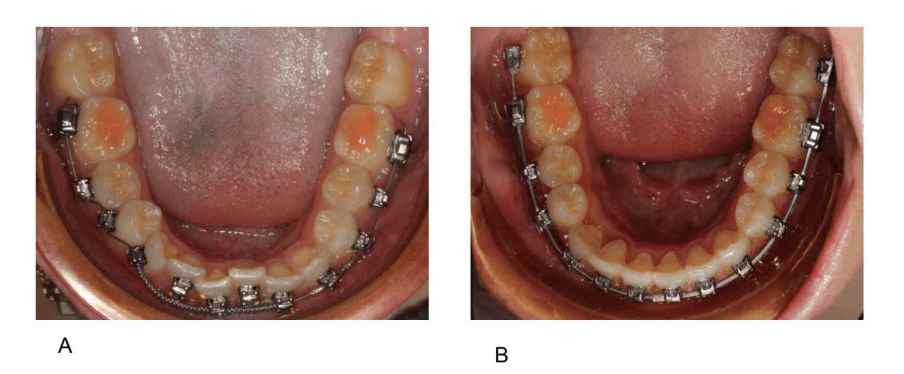 Evaluating the Damon Ultima System’s New Passive Self-Ligating Bracket ...