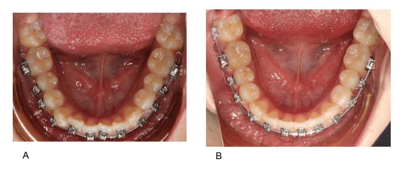 Evaluating the Damon Ultima System’s New Passive Self-Ligating Bracket ...
