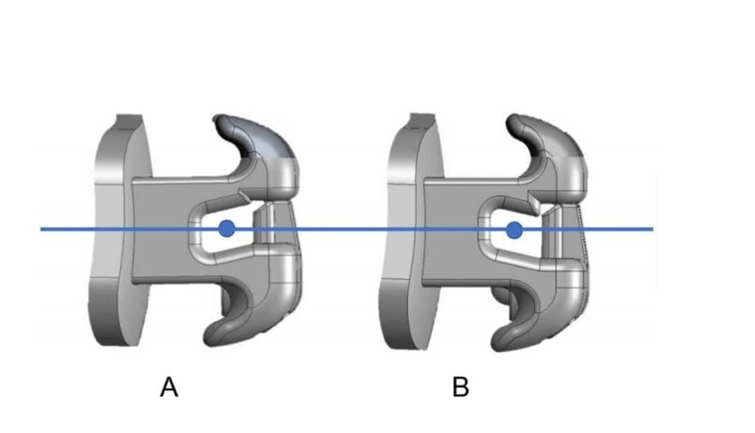Evaluating the Damon Ultima System’s New Passive Self-Ligating Bracket ...