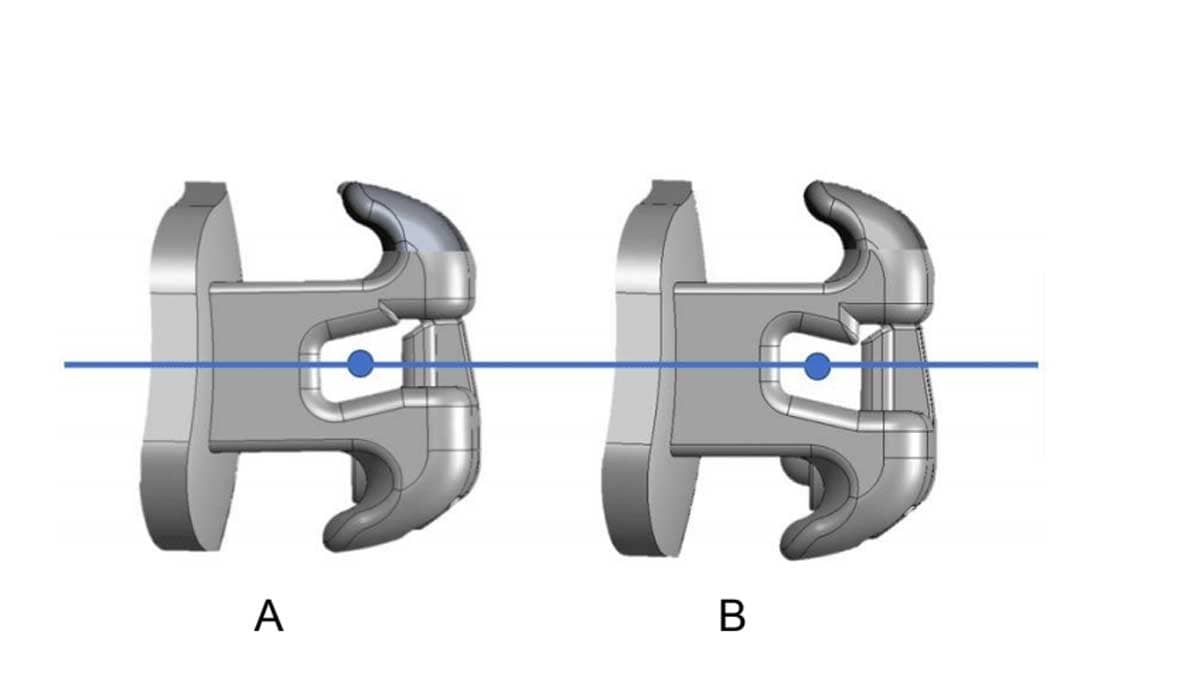 Evaluating the Damon Ultima System’s New Passive Self-Ligating Bracket ...