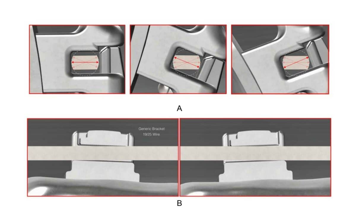 Evaluating the Damon Ultima System’s New Passive Self-Ligating Bracket ...