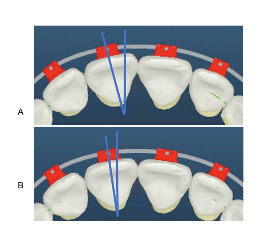 Evaluating the Damon Ultima System’s New Passive Self-Ligating Bracket ...