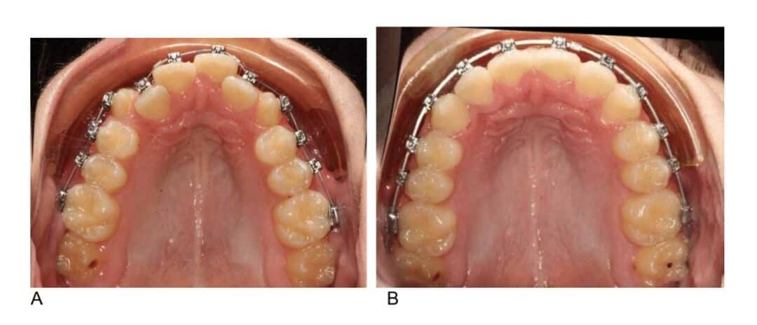 Evaluating the Damon Ultima System’s New Passive Self-Ligating Bracket ...