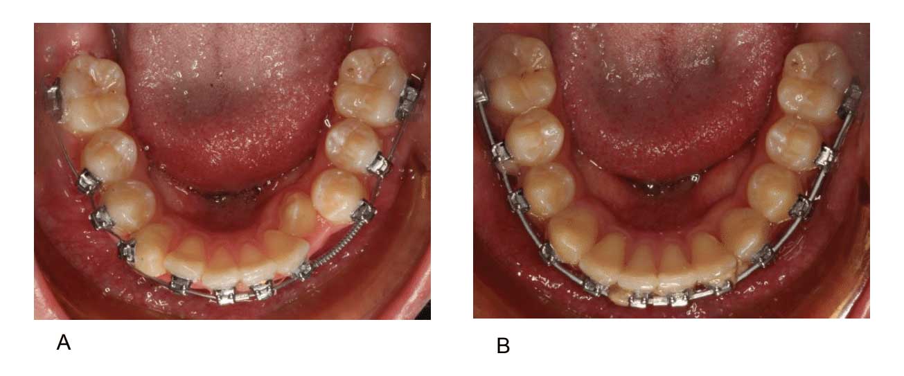 Evaluating the Damon Ultima System’s New Passive Self-Ligating Bracket ...