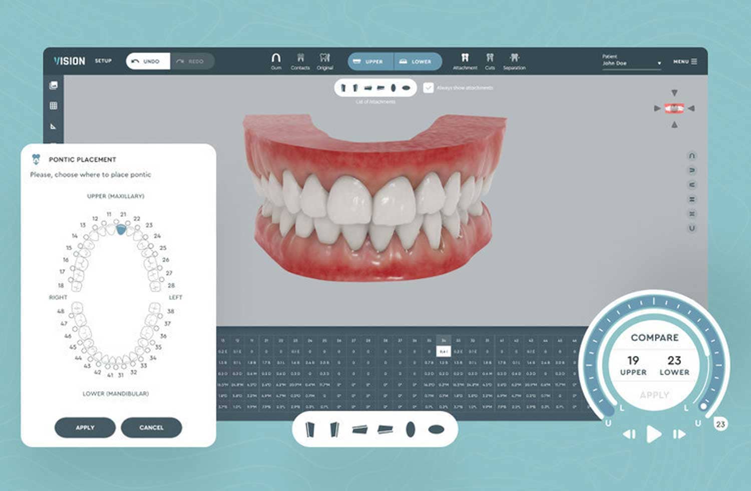 SoftSmile Upgrades its AI-Driven Aligner Treatment Planning Software ...