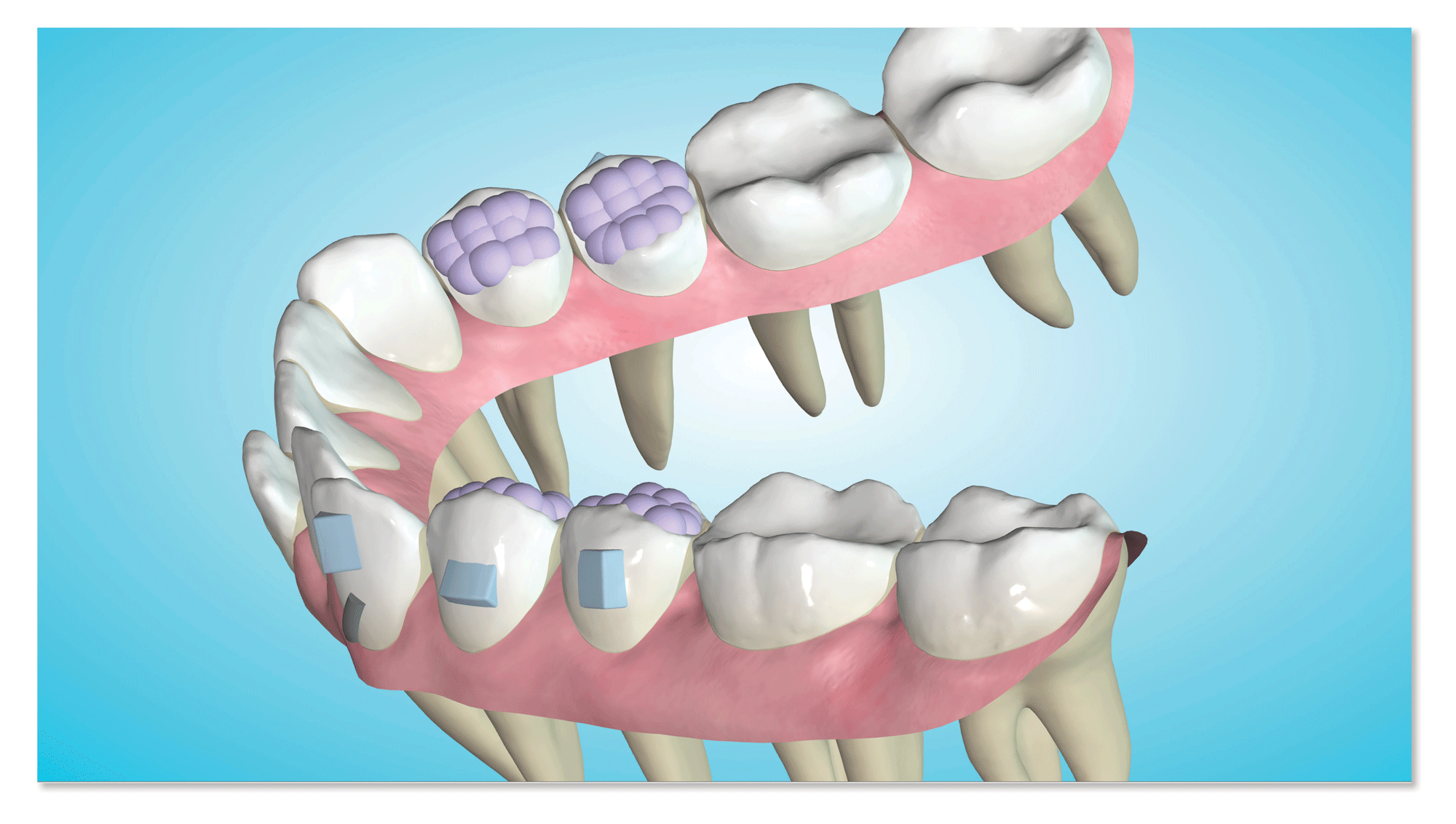 Ormco VP Rick Matty on the Latest Spark Clear Aligner Updates ...