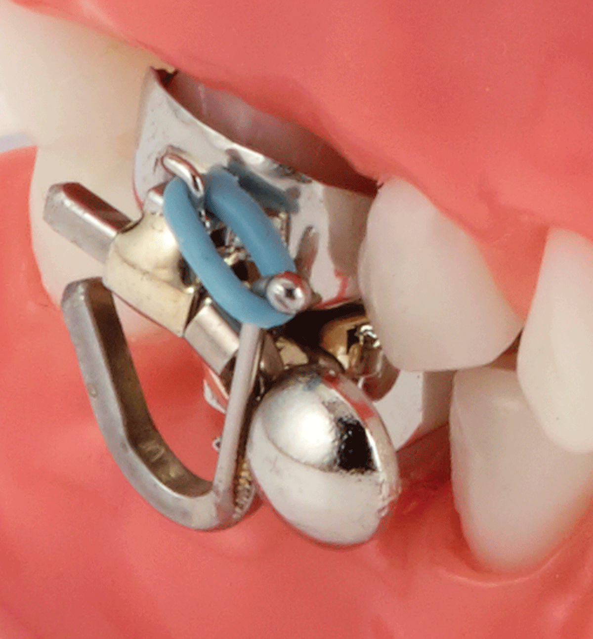 Focus On: Functional Appliances - Orthrodontic