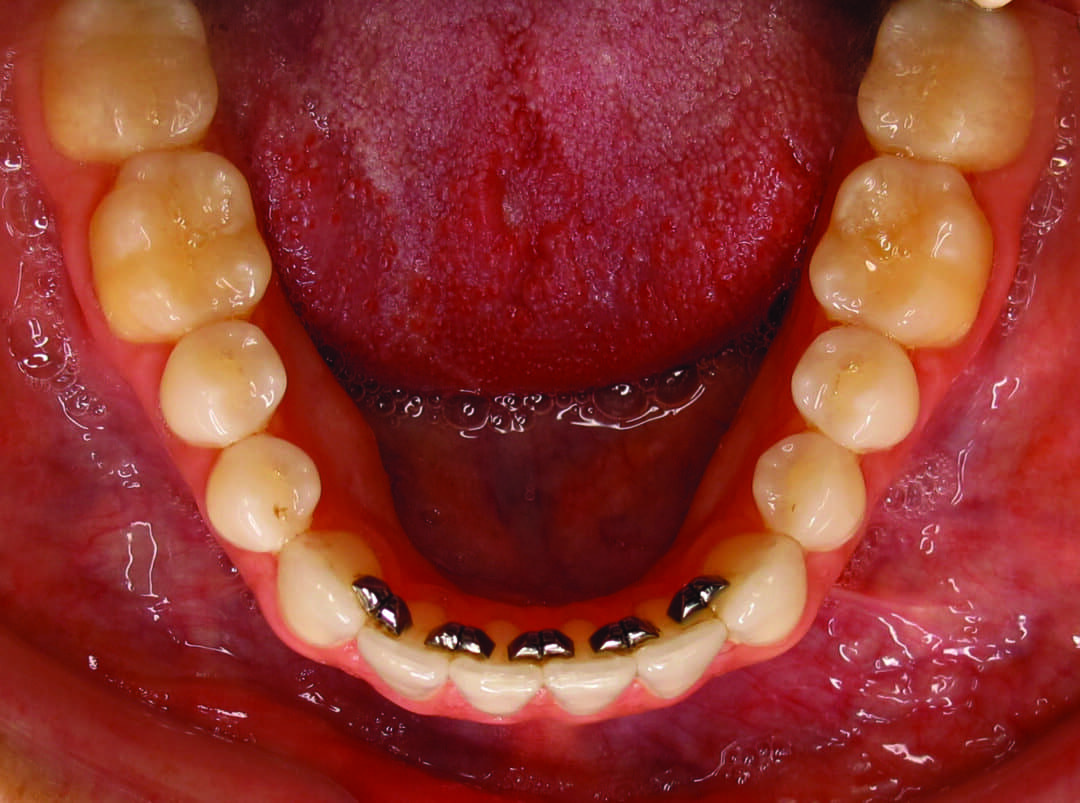 Focus On: Functional Appliances - Orthrodontic