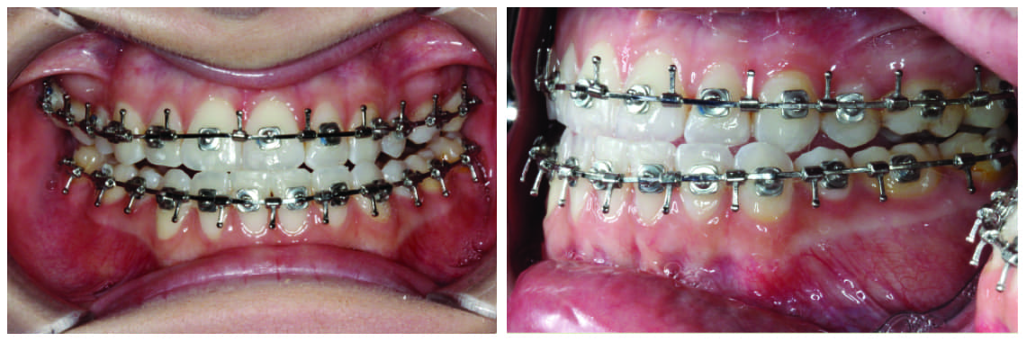 A Solution for Surgery Patients Undergoing Aligner Treatment