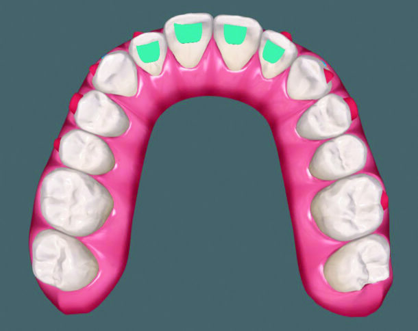 Dr Glaser’s 10 Commandments of Invisalign Treatment Design Revisited