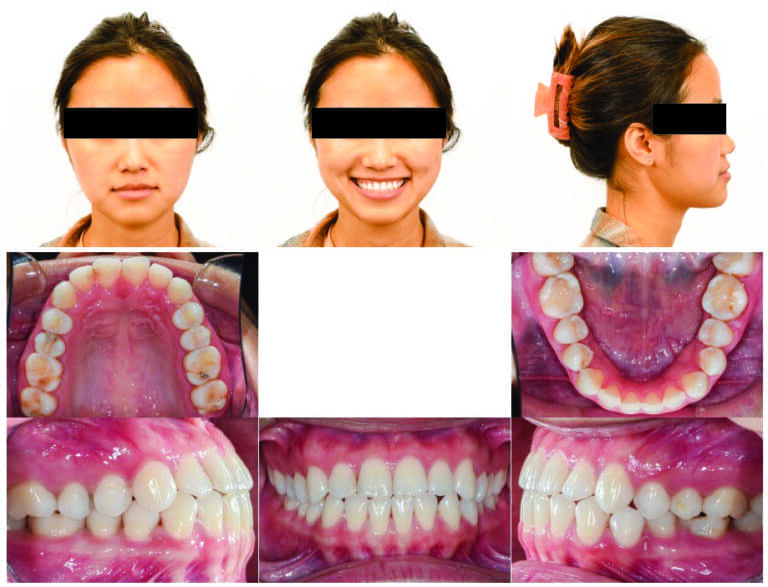 Incorporating Button Auxiliaries with Aligners for Severe Rotations
