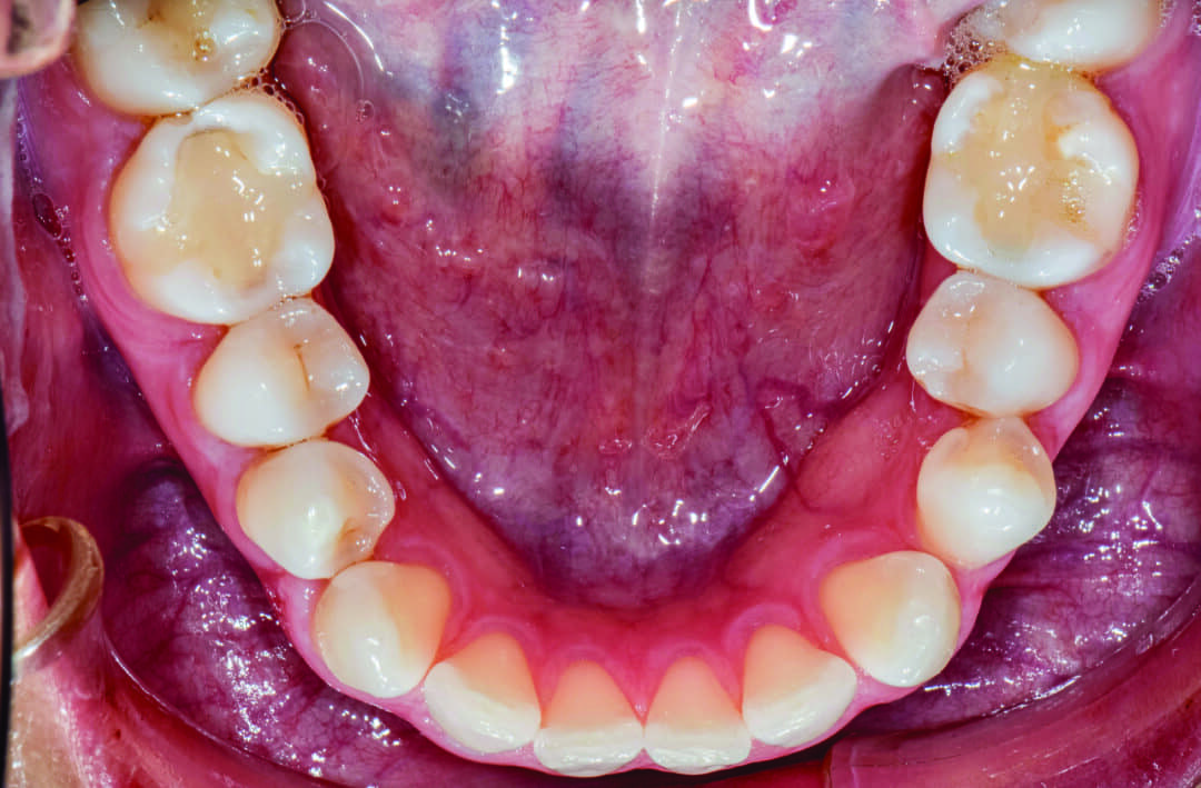 Incorporating Button Auxiliaries with Aligners for Severe Rotations