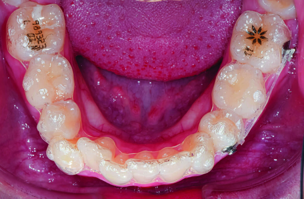 Incorporating Button Auxiliaries with Aligners for Severe Rotations