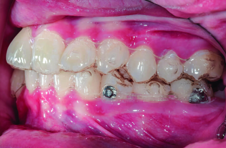 Incorporating Button Auxiliaries with Aligners for Severe Rotations