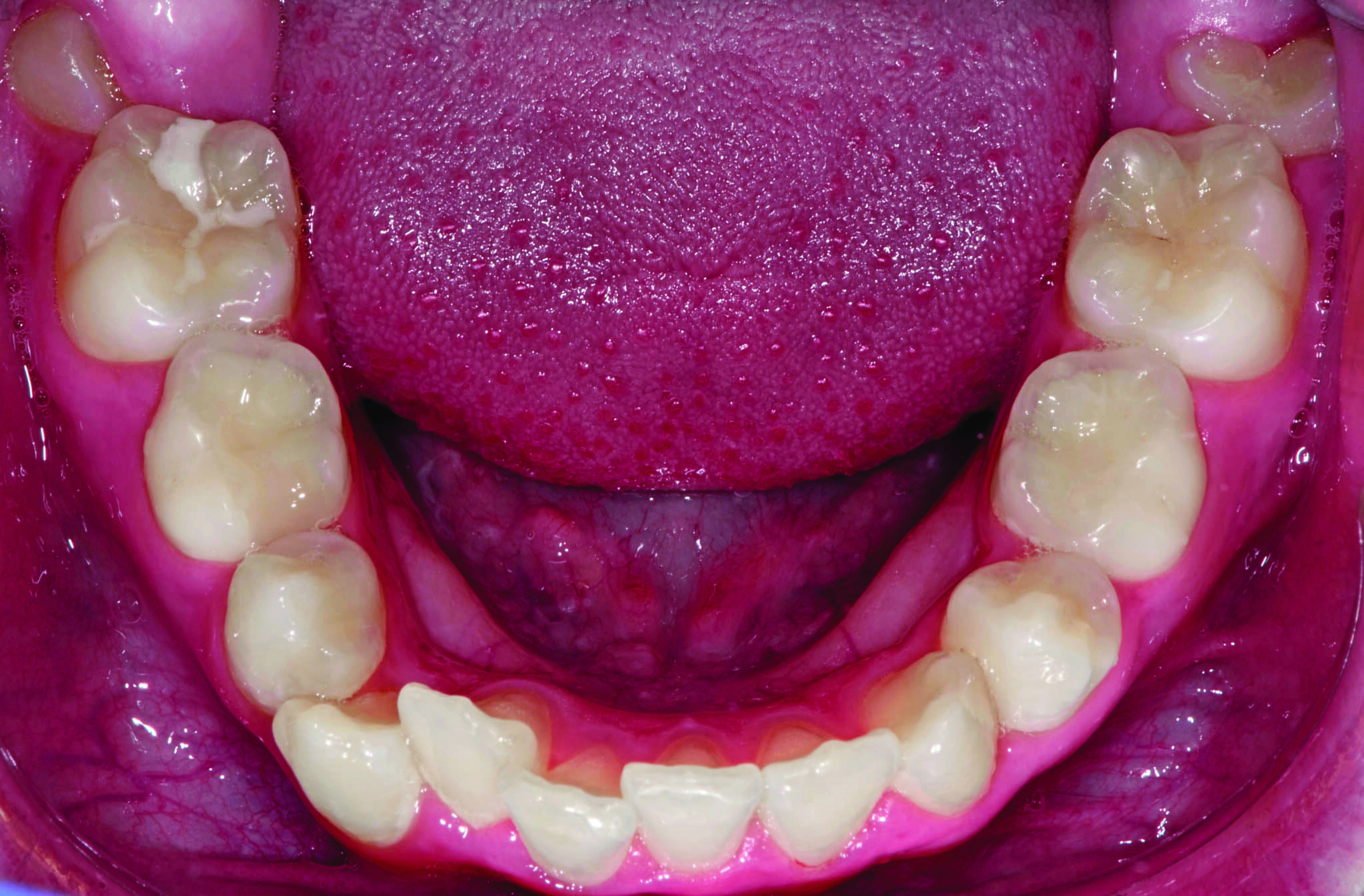 Incorporating Button Auxiliaries with Aligners for Severe Rotations