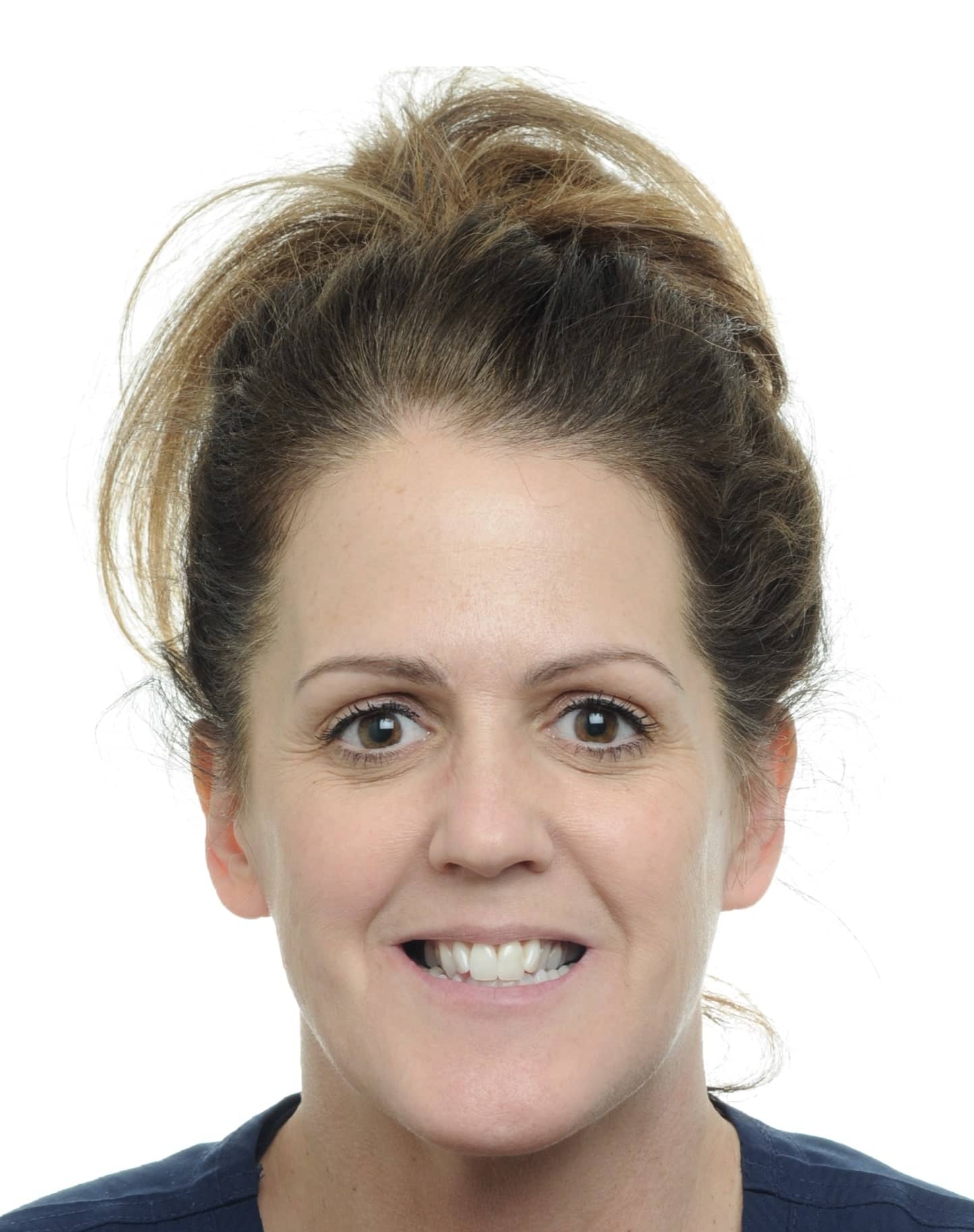 The 5 Keys to Creating Beautiful Smiles with Aligners