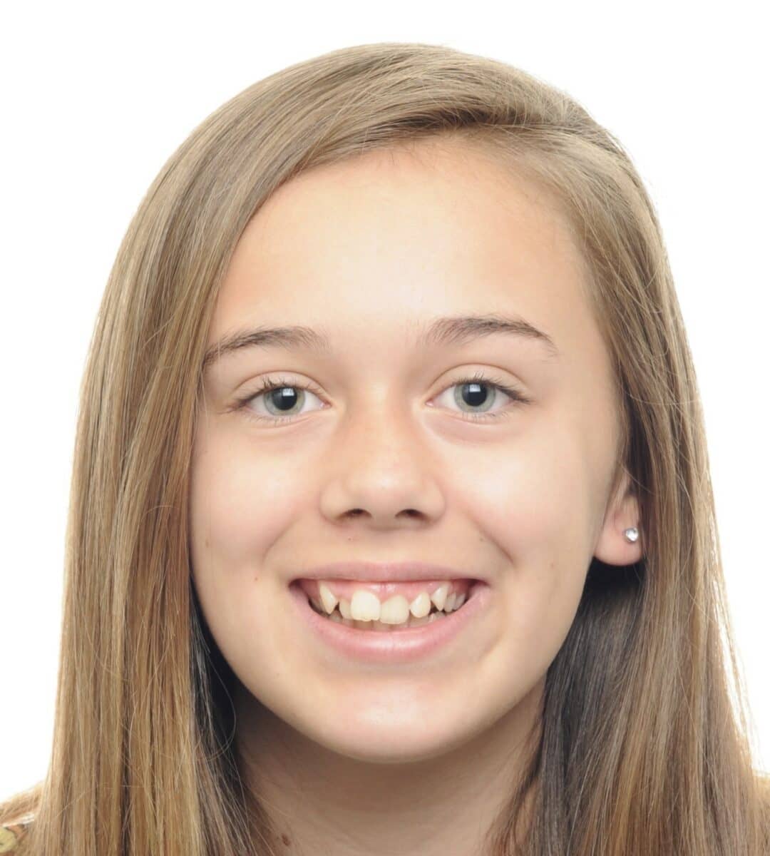 The 5 Keys to Creating Beautiful Smiles with Aligners