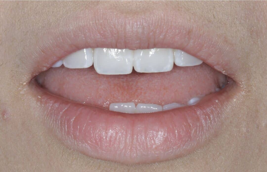 The 5 Keys To Creating Beautiful Smiles With Aligners - Orthrodontic