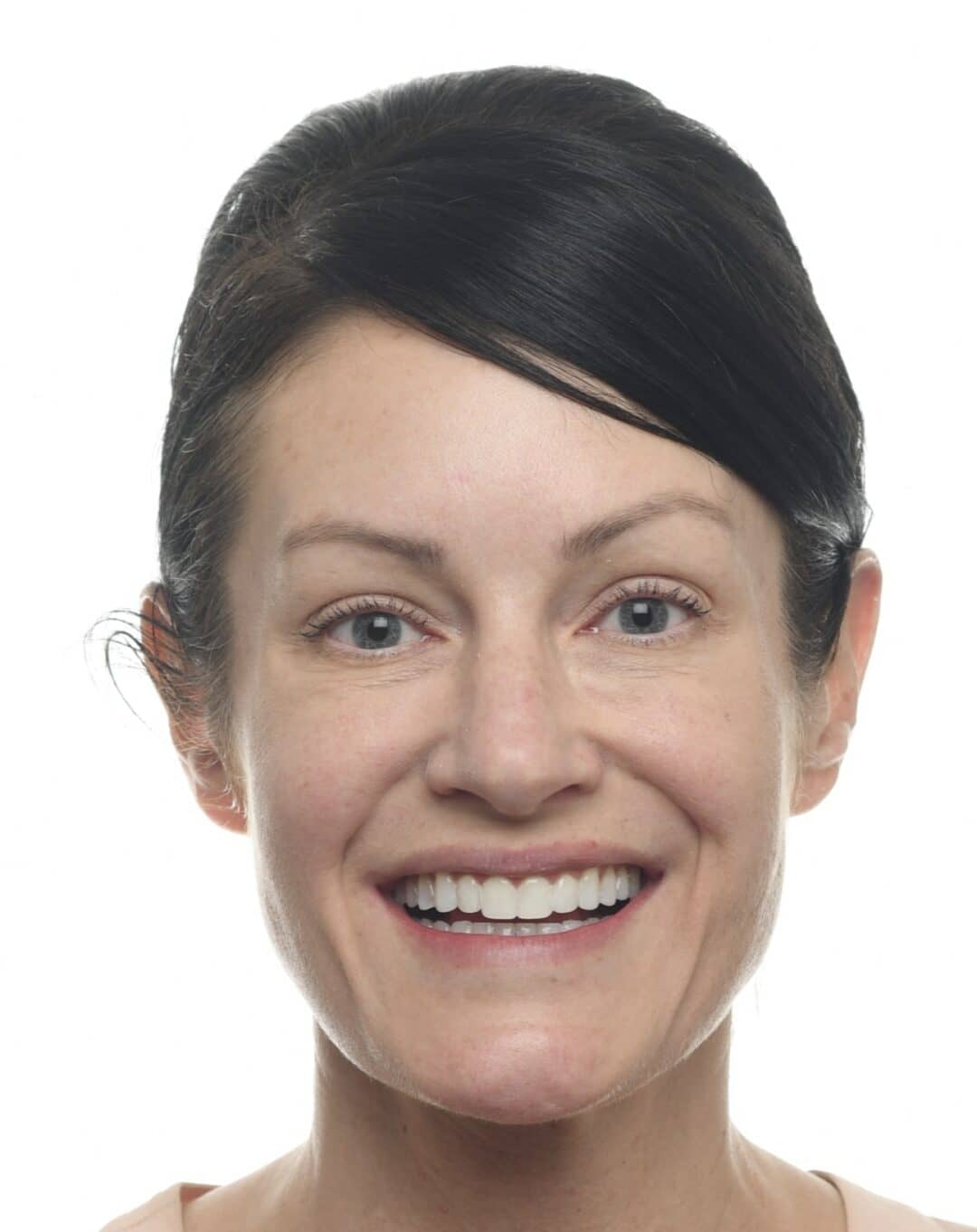 The 5 Keys to Creating Beautiful Smiles with Aligners