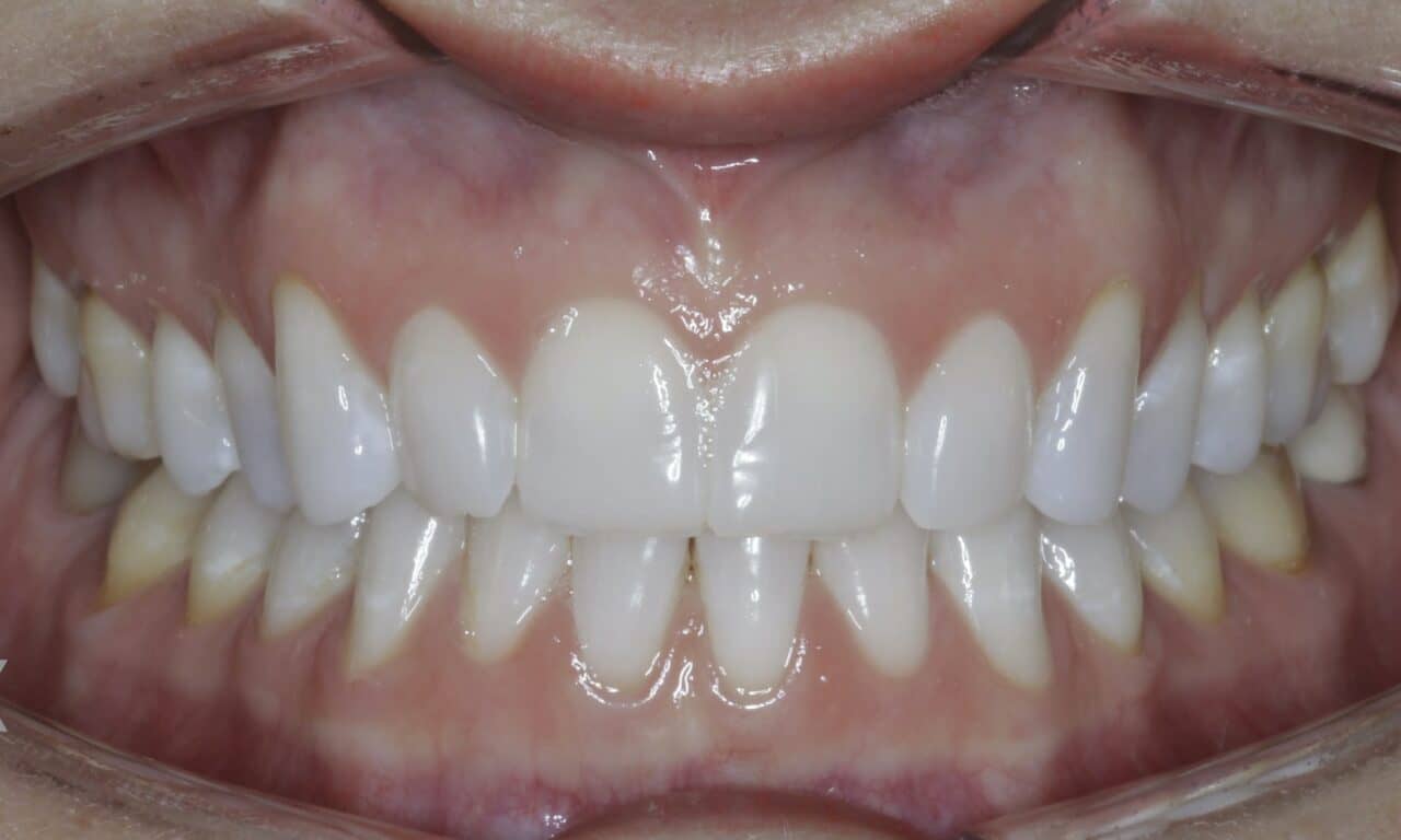 The 5 Keys to Creating Beautiful Smiles with Aligners