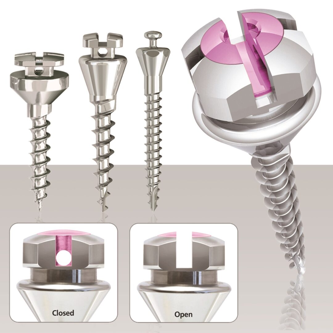 Focus On: 2022 TADs | Orthodontic Products