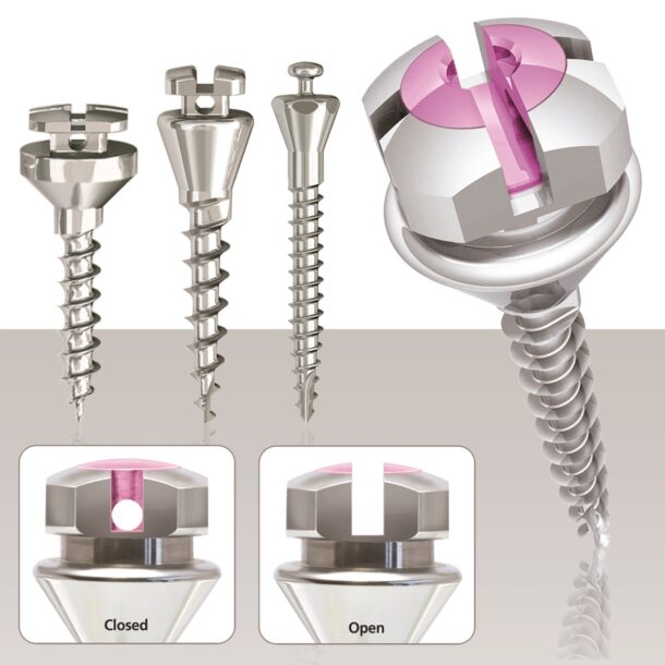 Focus On: 2022 TADs | Orthodontic Products