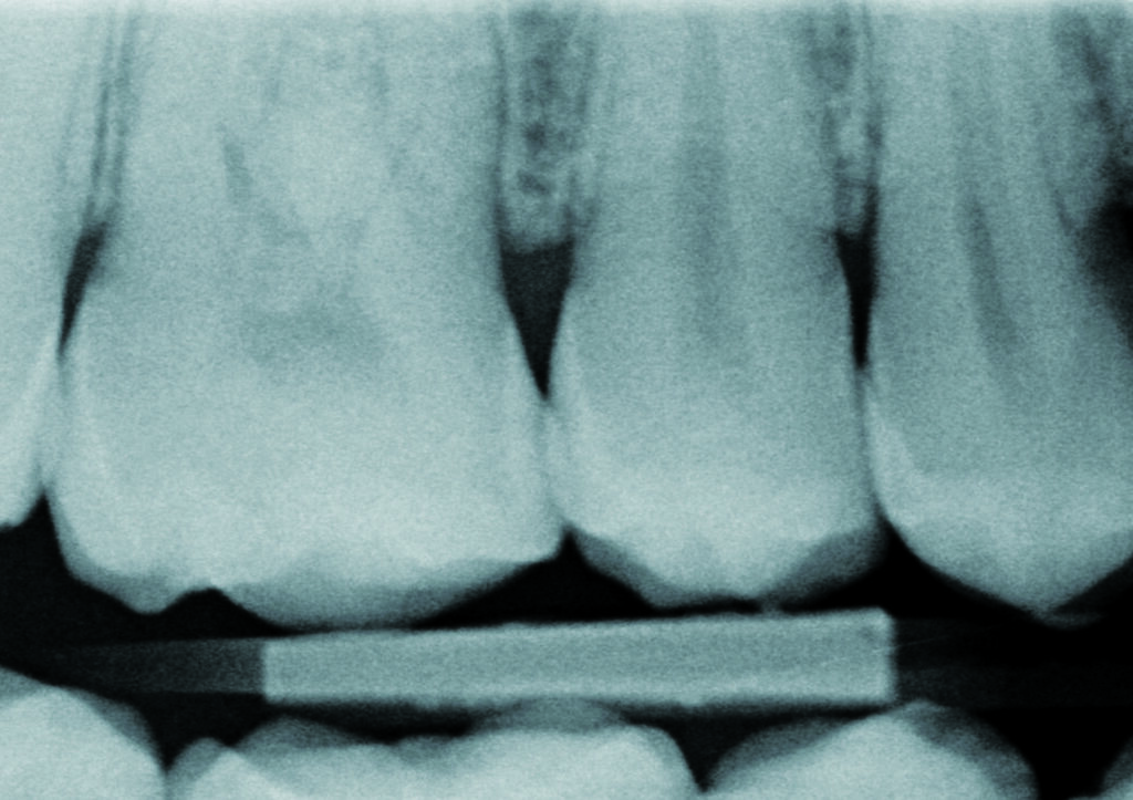 Curodont: A “Cure” for White Spot Lesions? | Orthodontic Products