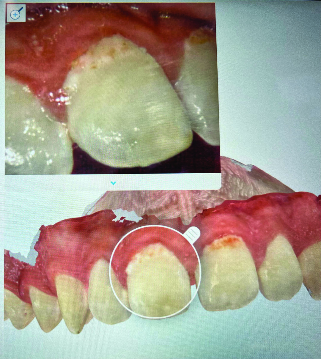 Clinical Pearl: Steps for Intraoral Scanning Success