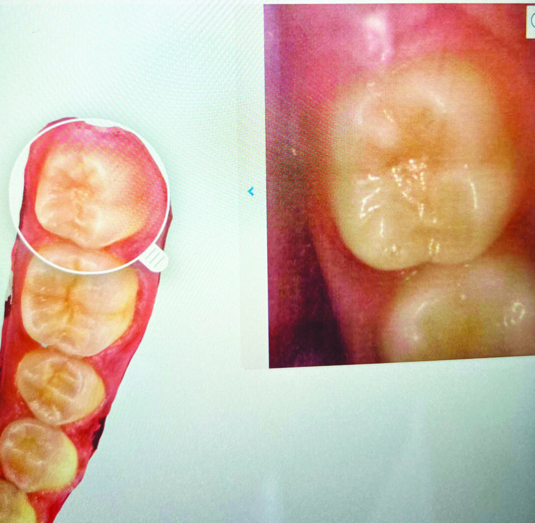 Clinical Pearl: Steps for Intraoral Scanning Success