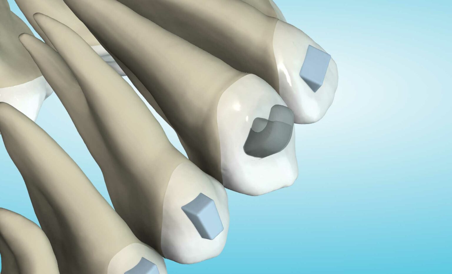 Ormco VP Breaks Down Spark Clear Aligner Release 13