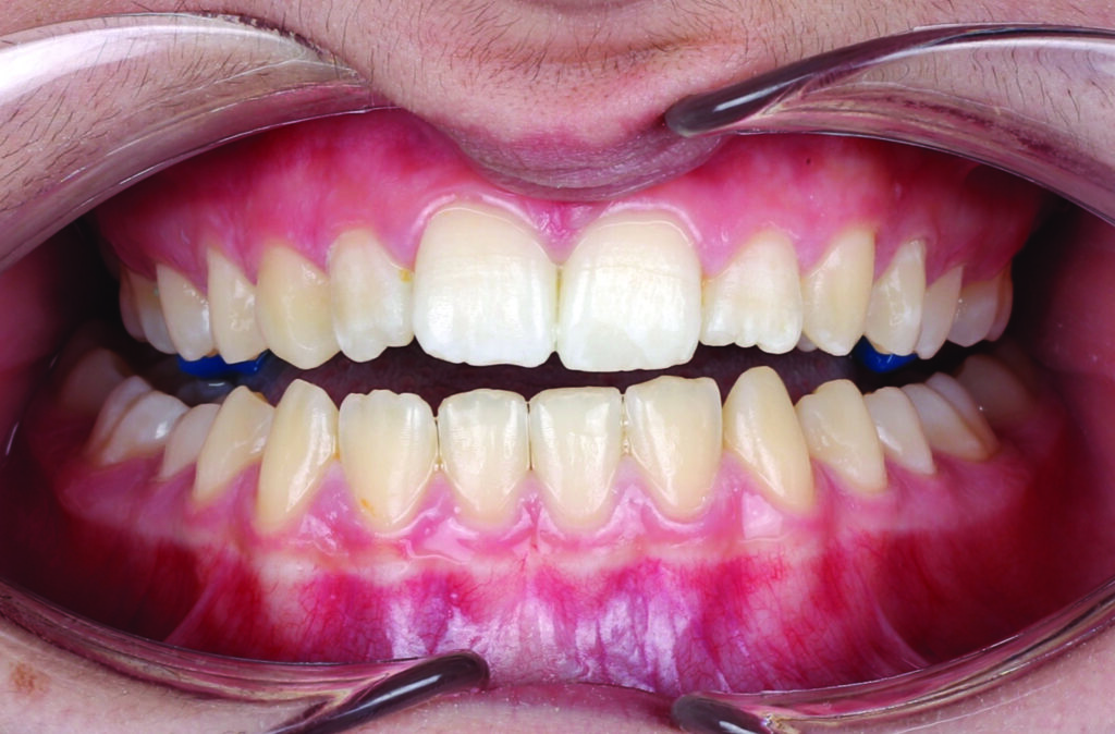 Brava, a Novel Orthodontic System Resolves a Functional Shift