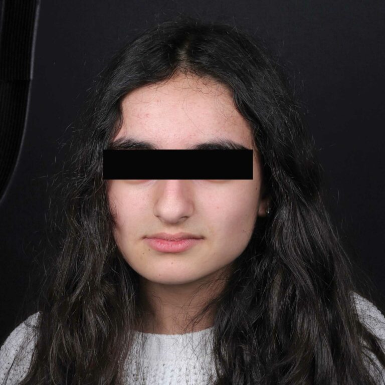 Brava, a Novel Orthodontic System Resolves a Functional Shift