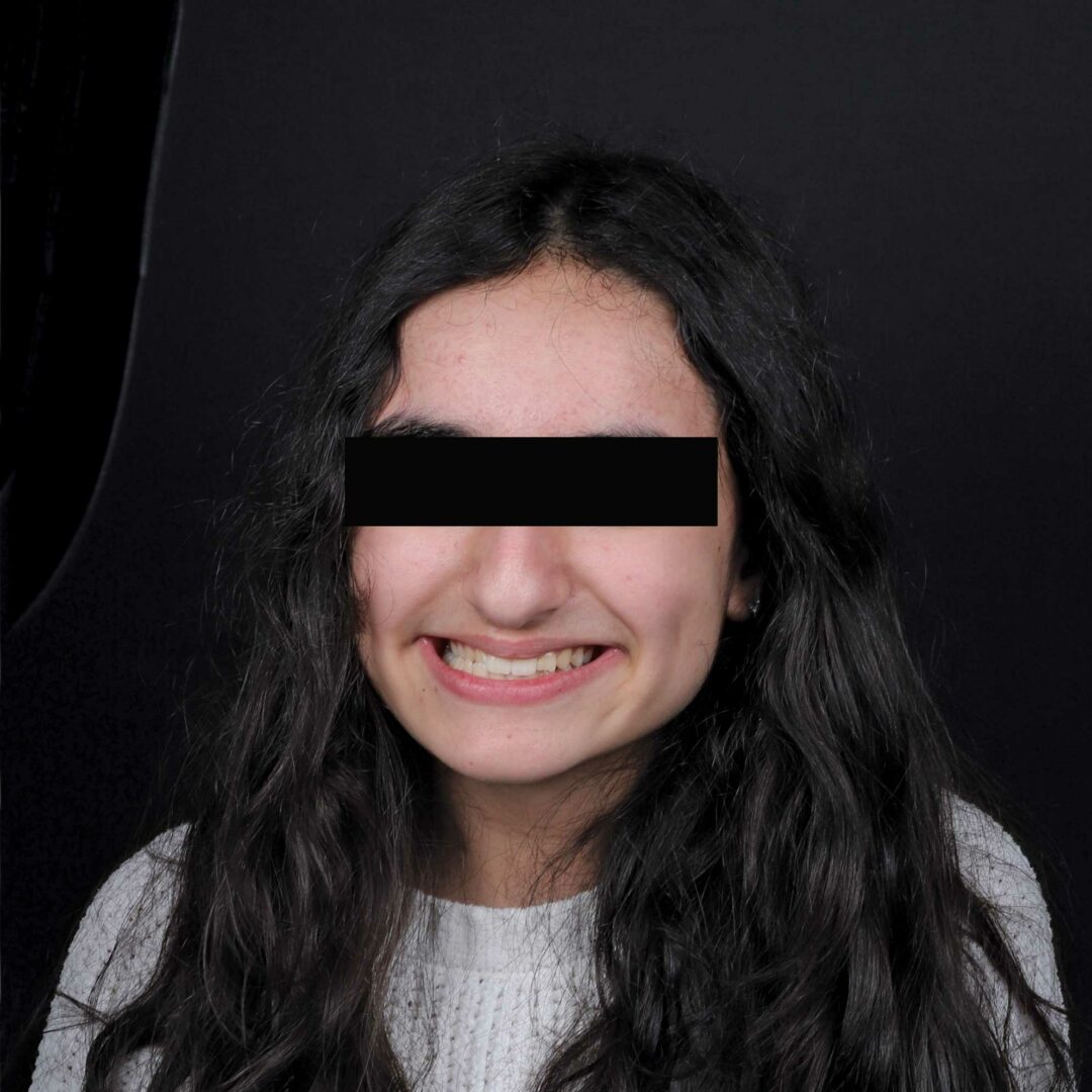 Brava, a Novel Orthodontic System Resolves a Functional Shift