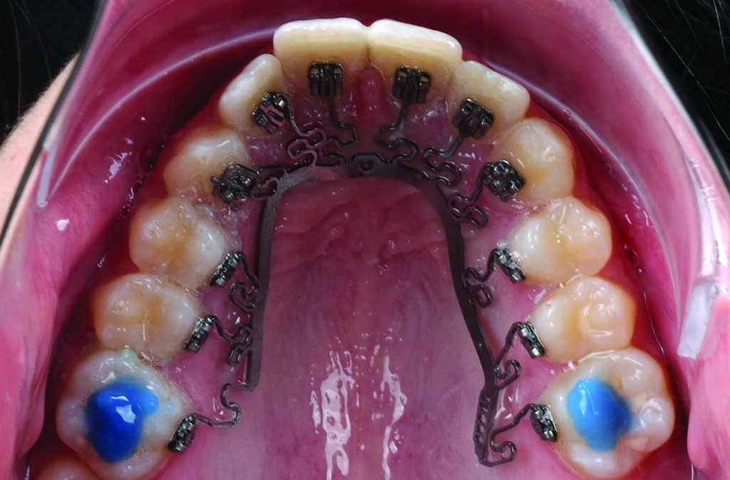 Brava, a Novel Orthodontic System Resolves a Functional Shift