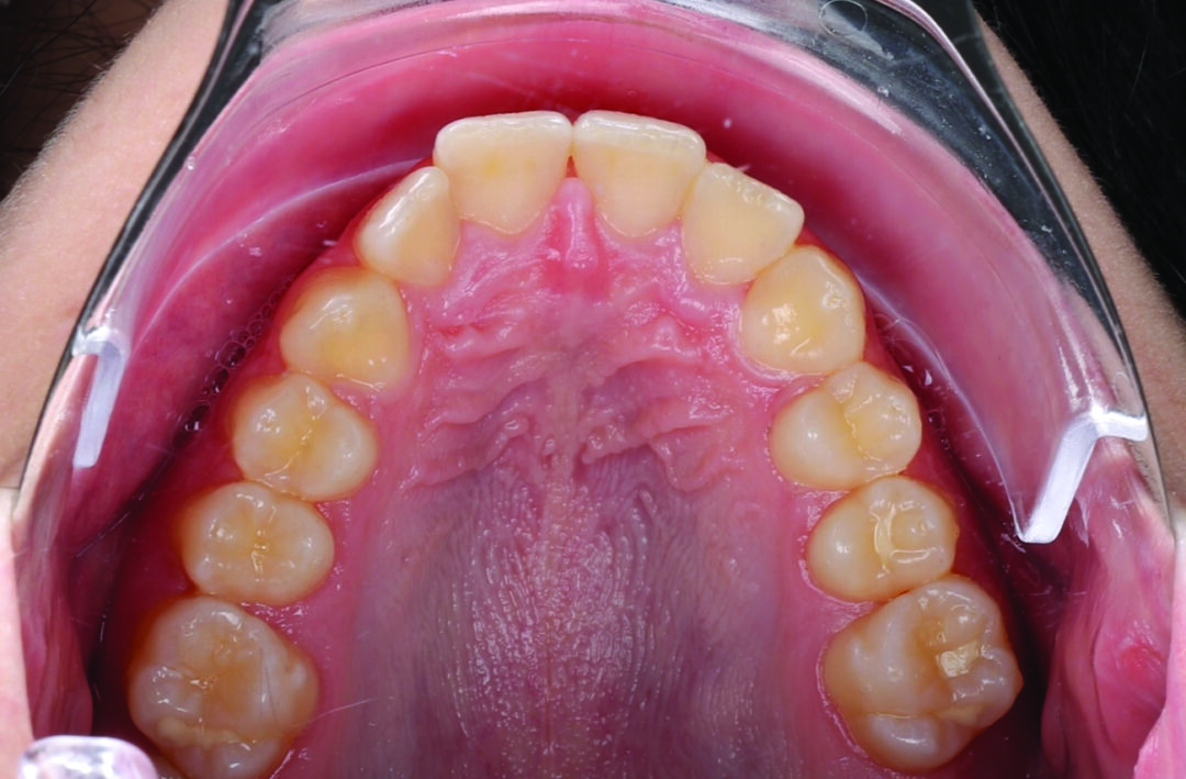 Brava, a Novel Orthodontic System Resolves a Functional Shift