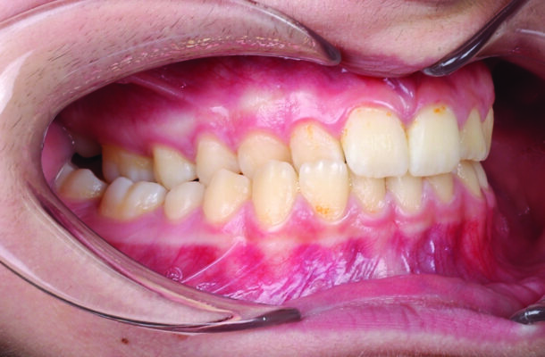 Brava, a Novel Orthodontic System Resolves a Functional Shift