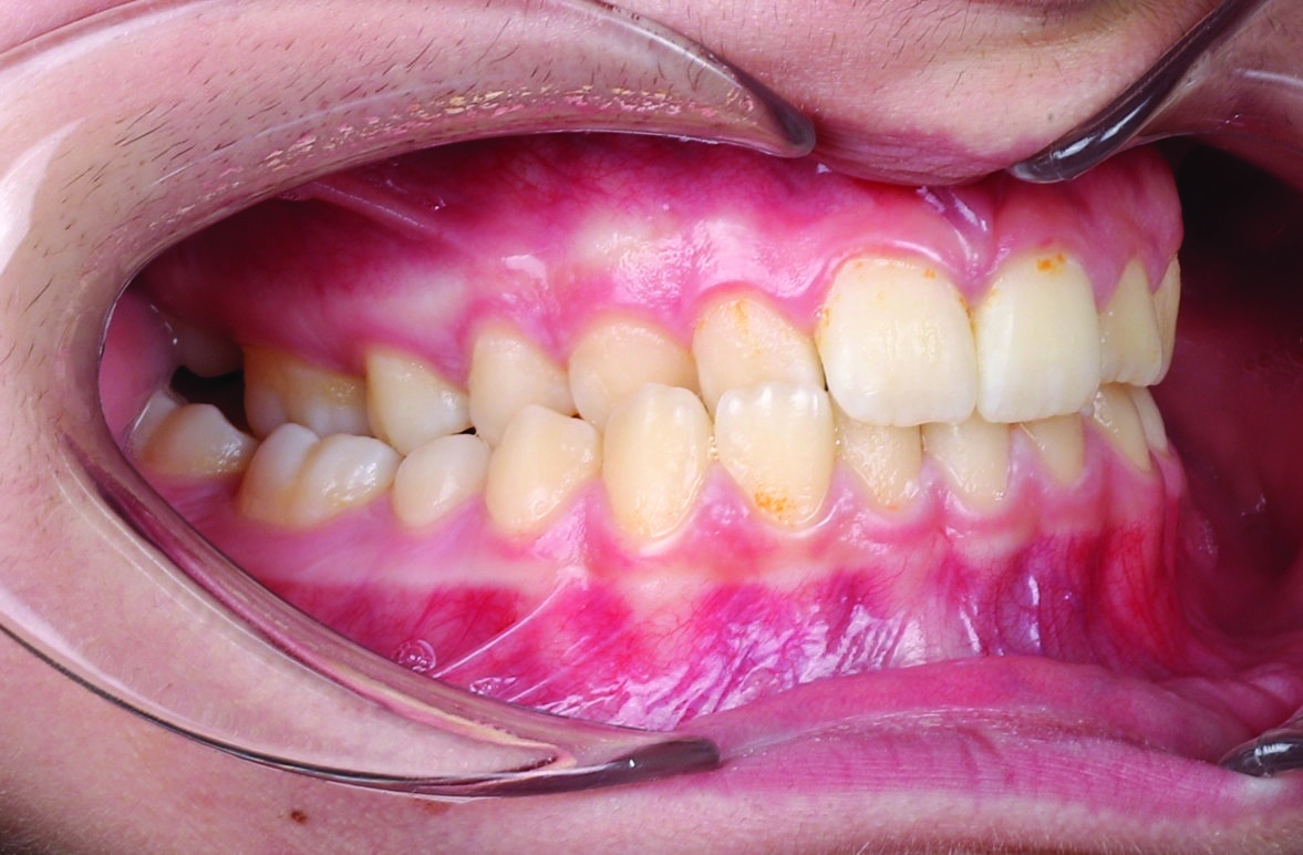 Brava, a Novel Orthodontic System Resolves a Functional Shift