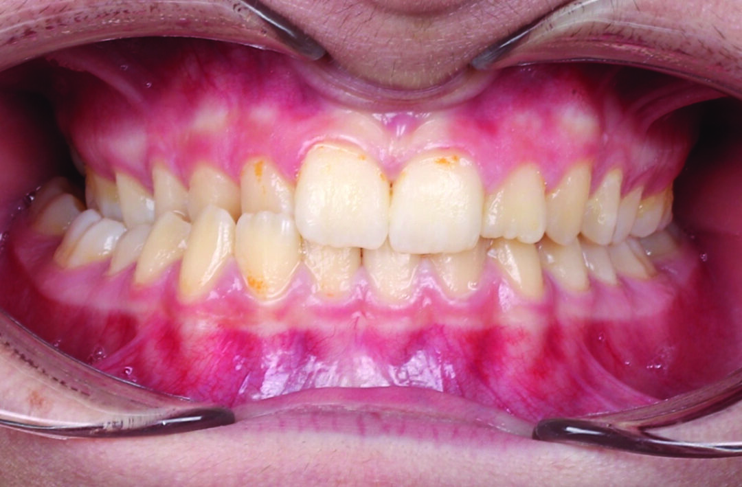 Brava, a Novel Orthodontic System Resolves a Functional Shift