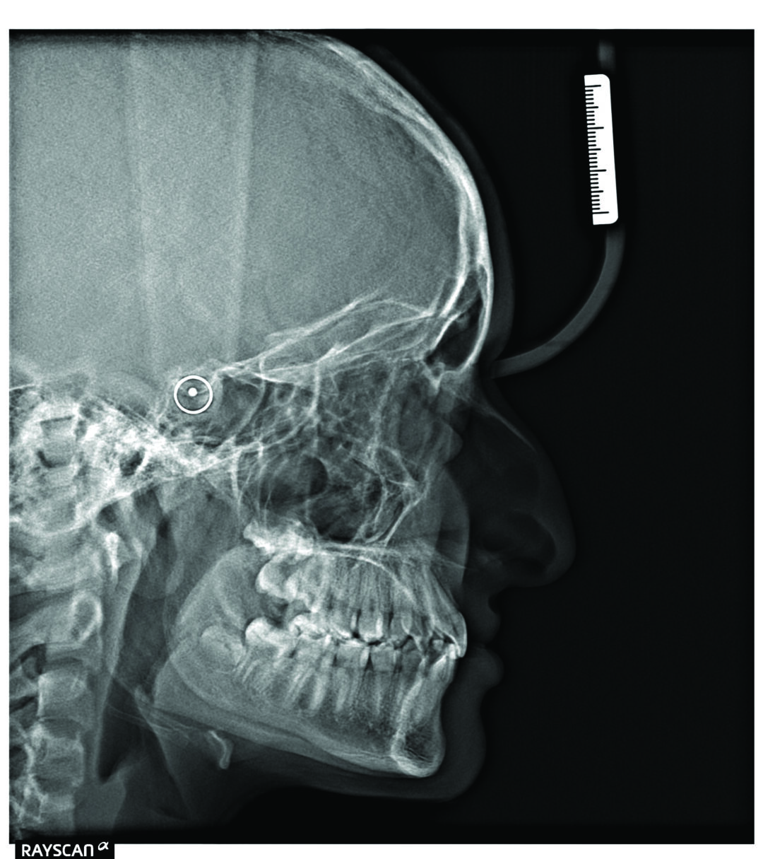 Brava, a Novel Orthodontic System Resolves a Functional Shift