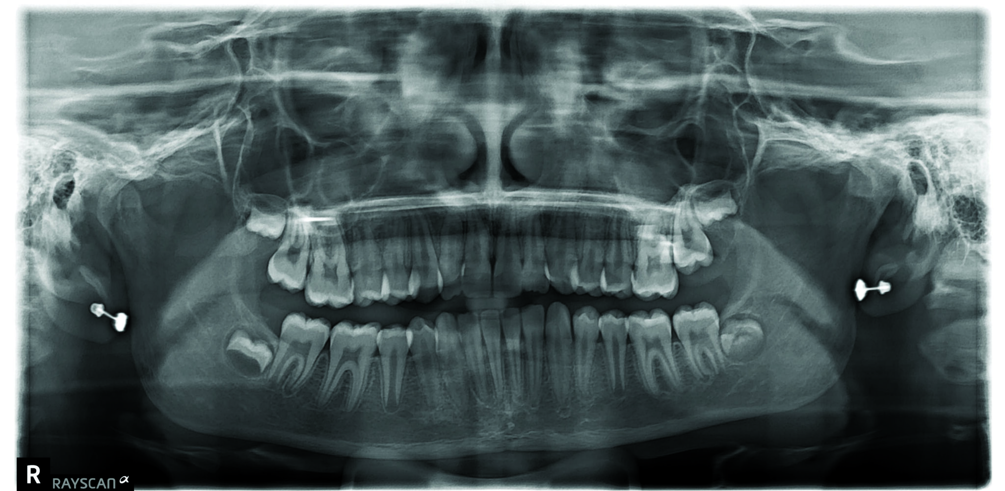Brava, a Novel Orthodontic System Resolves a Functional Shift